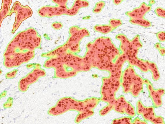 Breast PR AI for Breast Cancer Sample Analysis