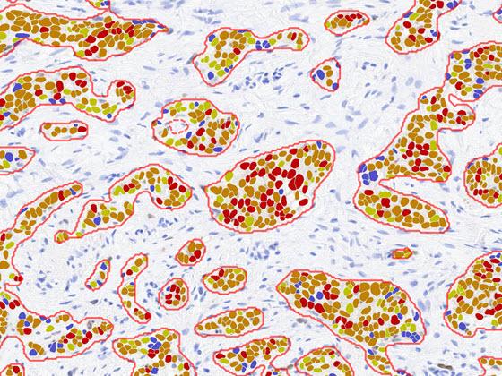 Breast ER AI for Breast Cancer Sample Analysis