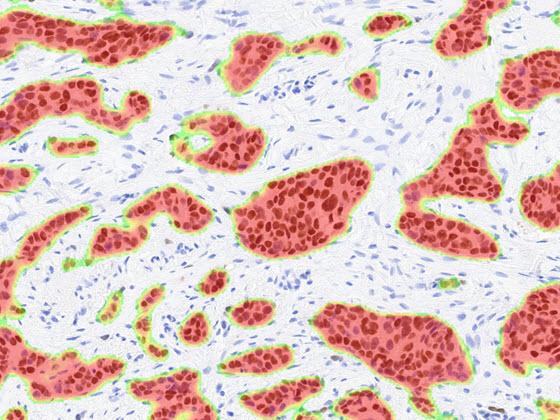 Breast ER AI for Breast Cancer Sample Analysis