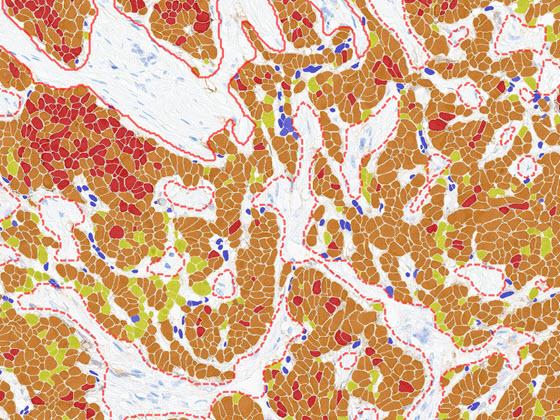 Breast HER2 AI for Breast Cancer Sample Analysis